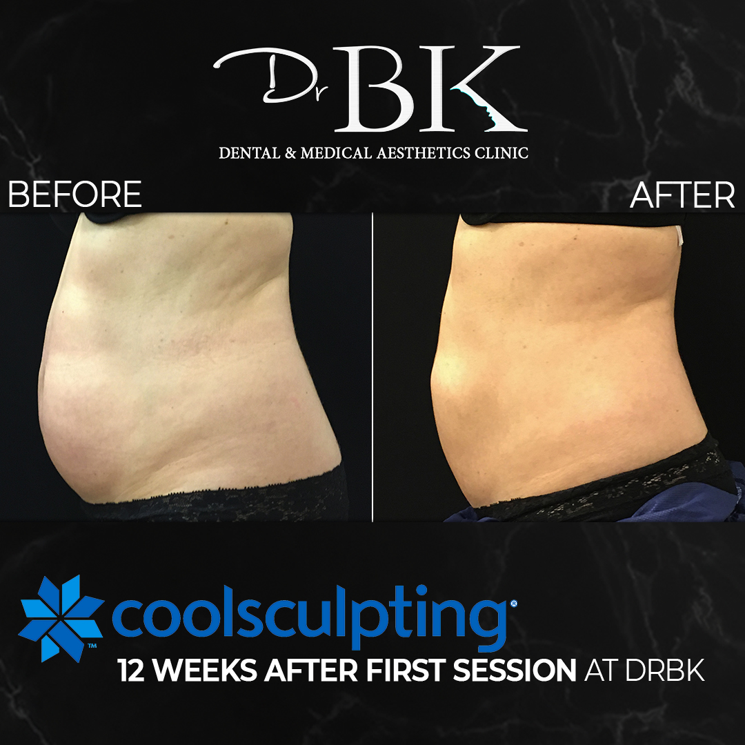 Coolsculpting® Fat Freezing Treatment - DrBK Clinic in Reading