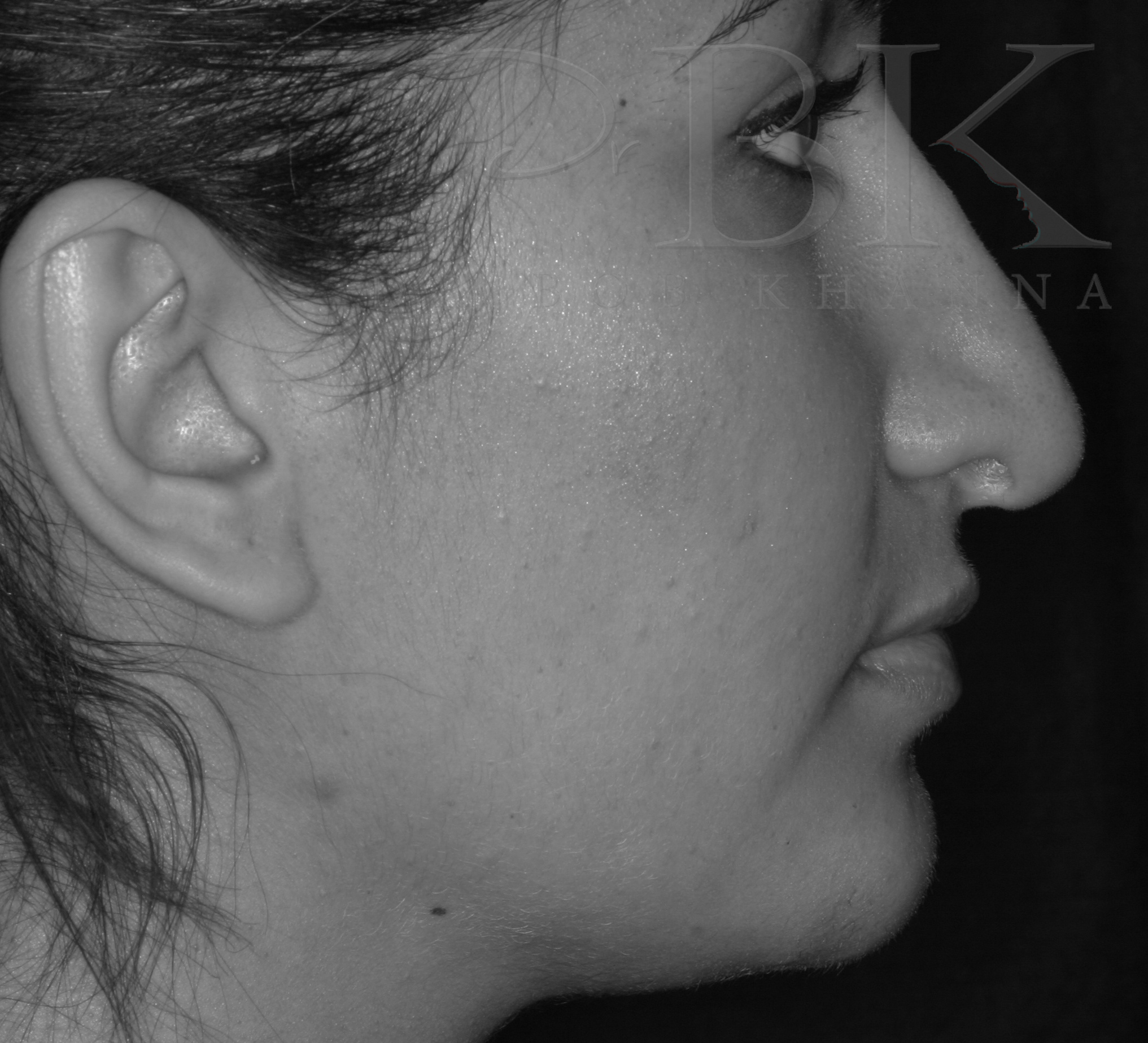 Chin Augmentation/Chin Filler - DrBK Aesthetics Clinic in Reading