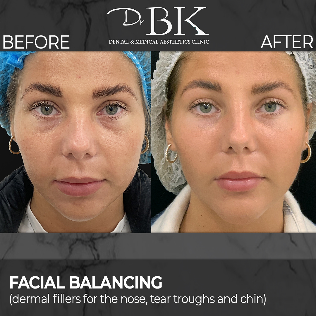 Full Face Treatment - DrBK Cosmetic Dentist & Aesthetics Clinic