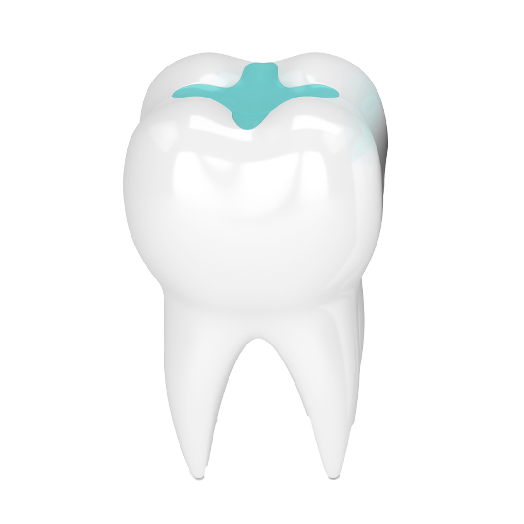 Dental Inlays - DrBK Cosmetic Dentist & Aesthetics Clinic in Reading