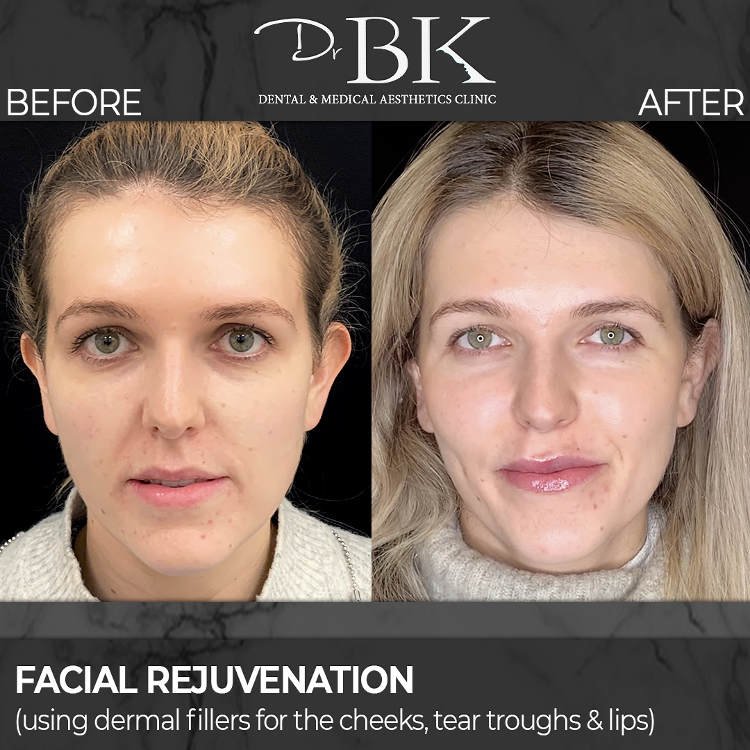 Non-Surgical Full Face Aesthetic Treatments | DrBK Clinics