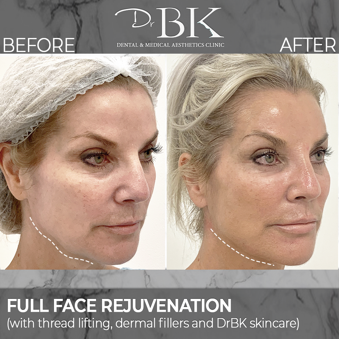 Full Face Treatment - DrBK Cosmetic Dentist & Aesthetics Clinic