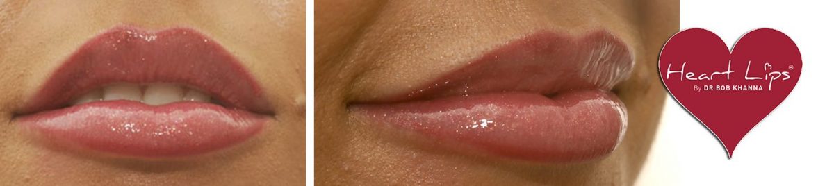 Lip Fillers & Heart Lips® - DrBK Cosmetic Dentist & Aesthetics Clinic