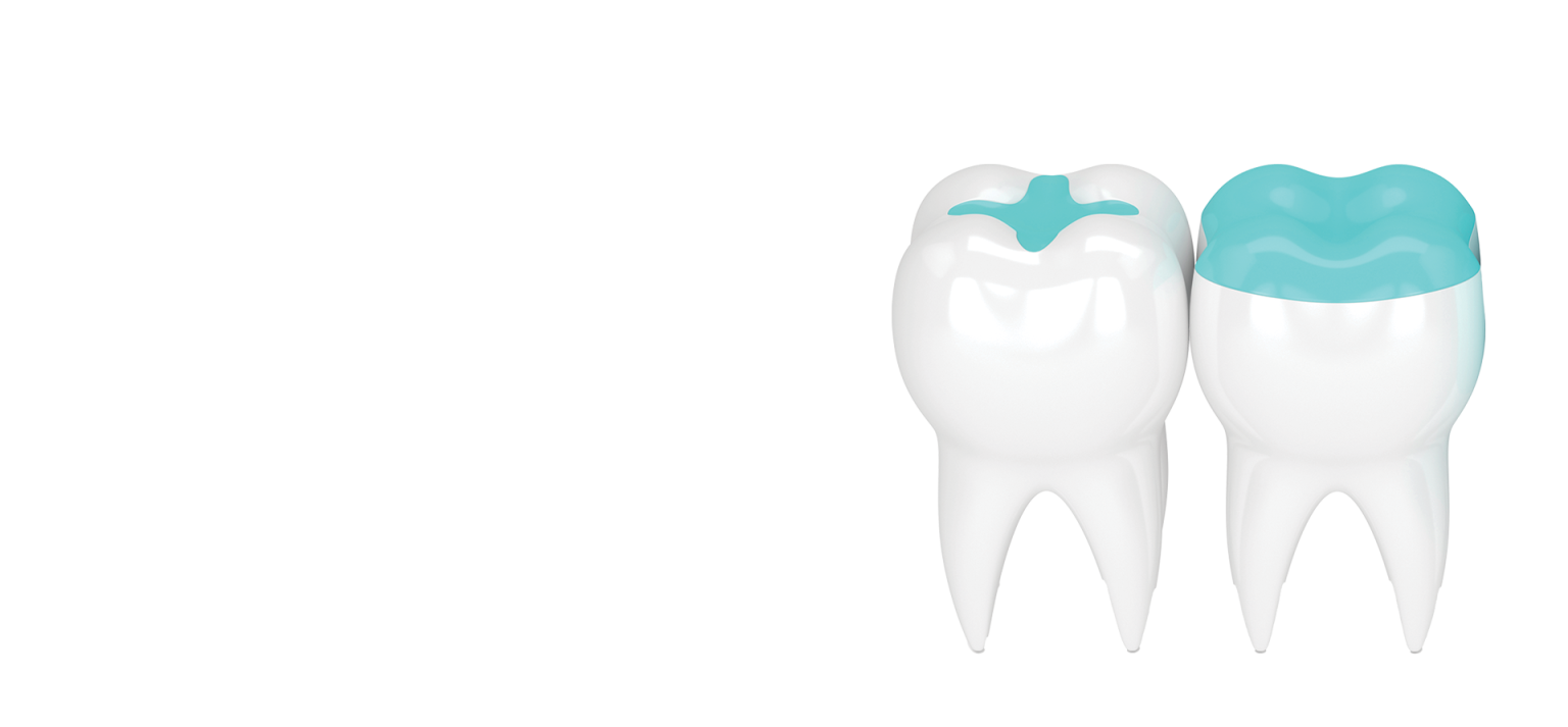 Dental Inlays - DrBK Cosmetic Dentist & Aesthetics Clinic in Reading