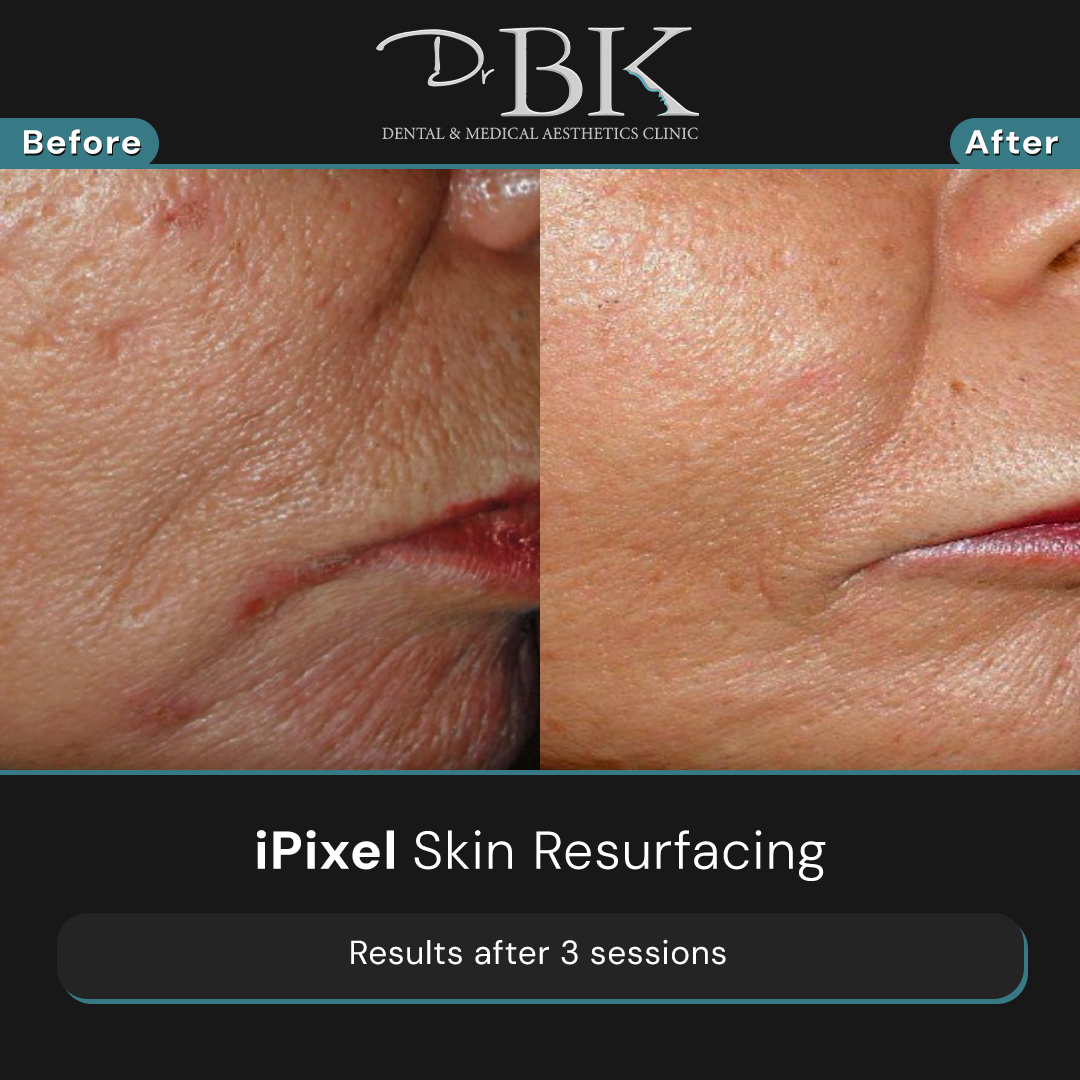 iPixel: Laser Skin Resurfacing