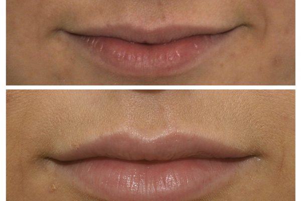 Lip Fillers & Heart Lips® - DrBK Cosmetic Dentist & Aesthetics Clinic