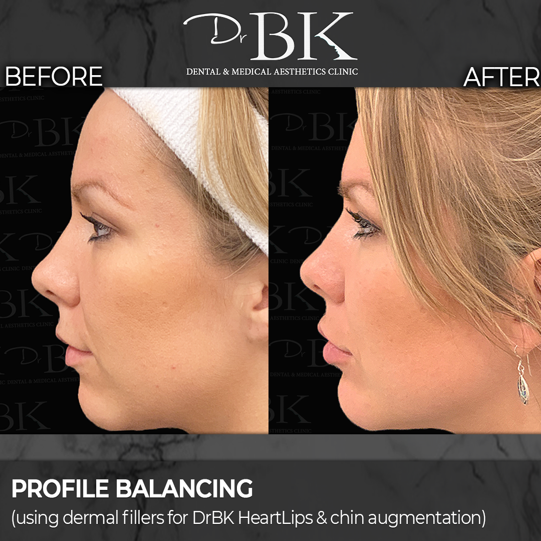 Before & After Pics of Aesthetic Treatments Available at DRBK