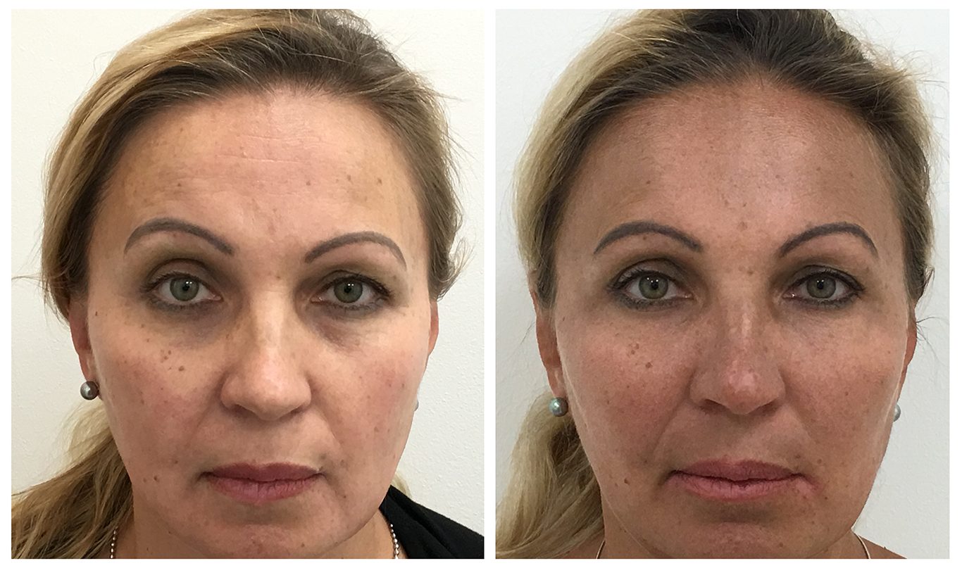 Tear Trough Treatment | DrBK Reading, Award Winning Clinic